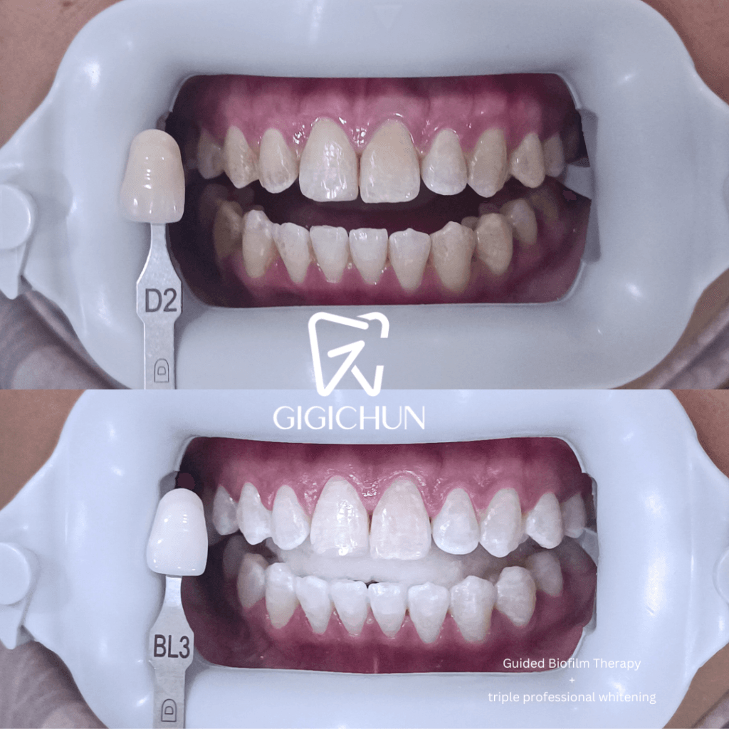 Guided Biofilm Therapy with EMS Airflow - GigiChun