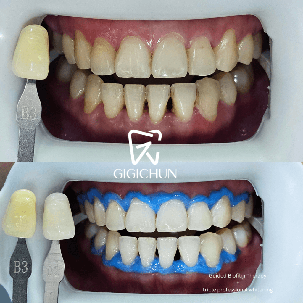 Guided Biofilm Therapy with EMS Airflow - GigiChun